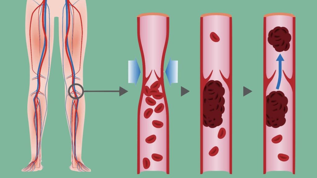 Warning Signs Of Blood Clot In The Leg at Amy Dixon blog